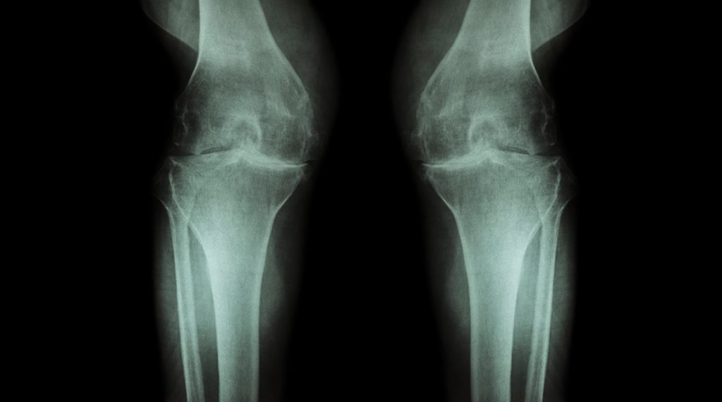 Arthrose: Ursachen, Sympthome und Prophylaxe