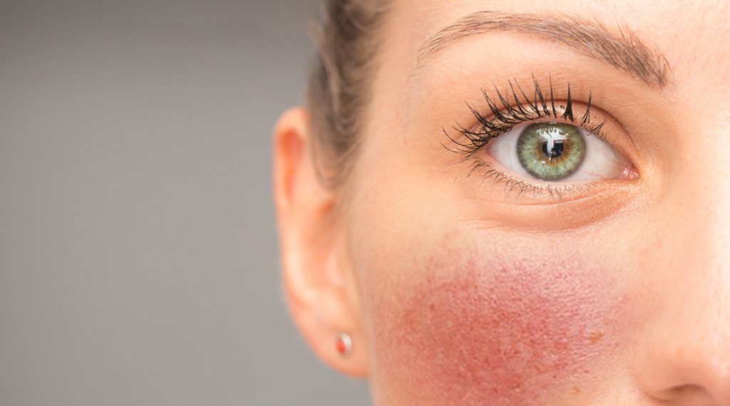 Couperose: Plötzlich rote und heiße Wangen